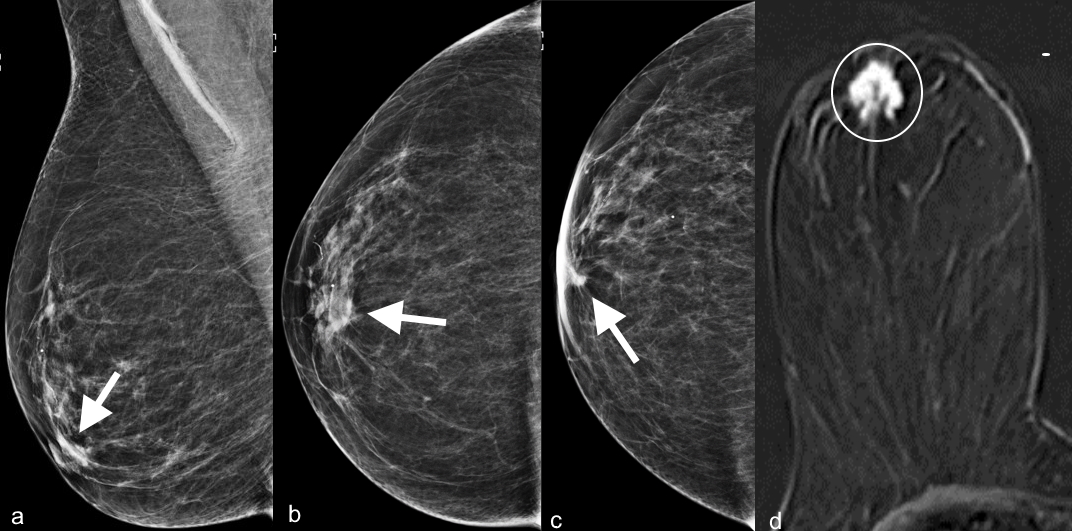 Detection of Subtle Breast Cancers with Mammography: The importance of ...
