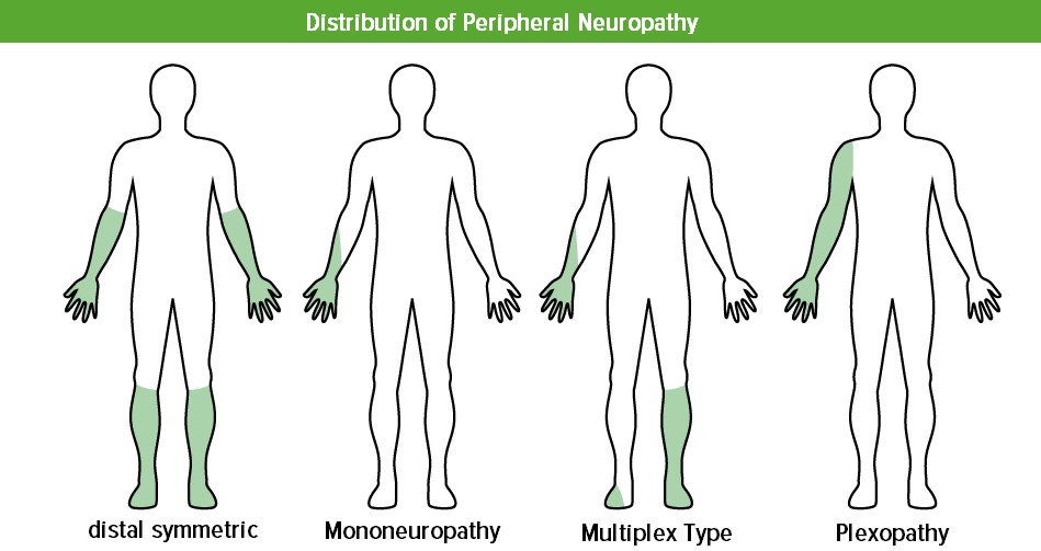 Diabetic Painful Neuropathy – Managing the Advanced Disease - myCME